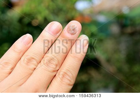 Fungus Infection On Image & Photo (Free Trial) | Bigstock