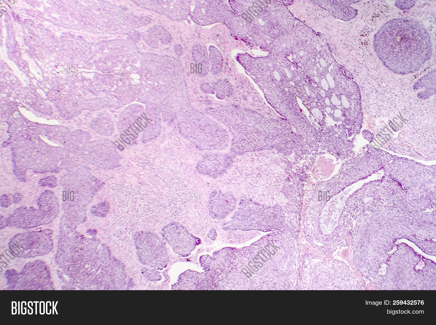Basal Cell Carcinoma, Image & Photo (Free Trial) | Bigstock