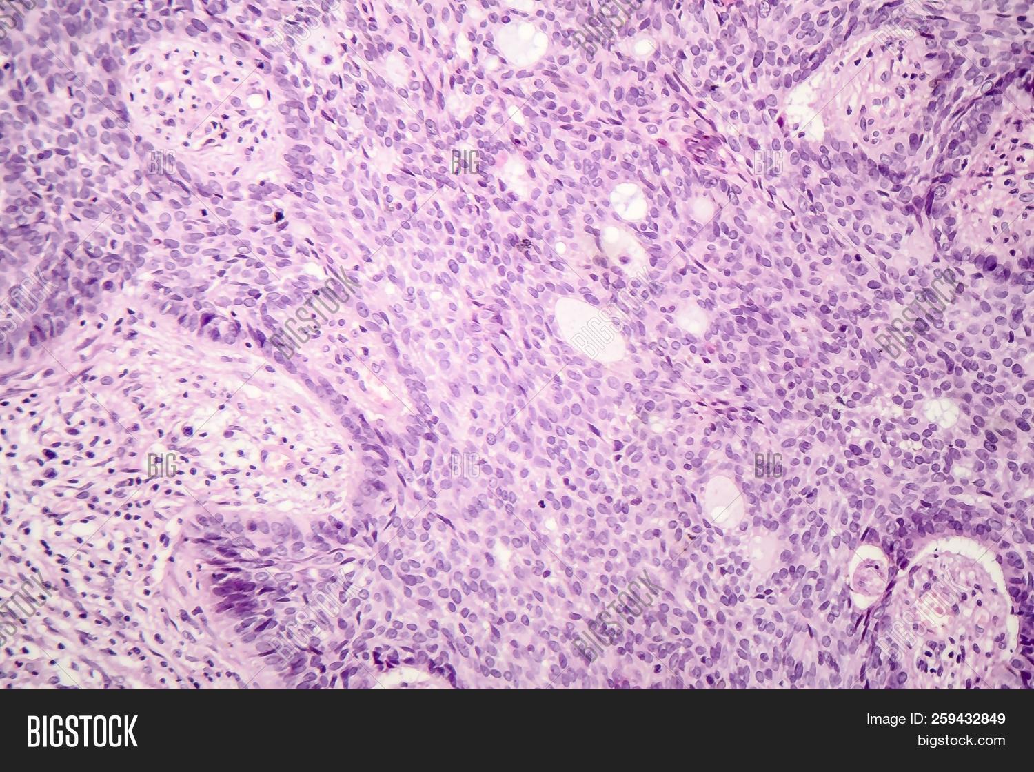 Basal Cell Carcinoma, Image & Photo (Free Trial) | Bigstock