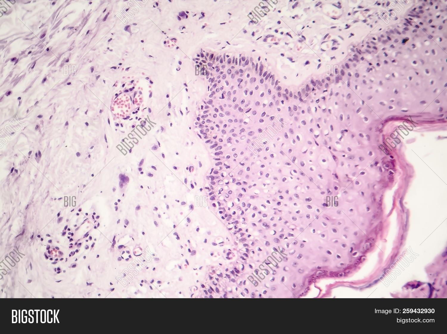 Basal Cell Carcinoma, Image & Photo (Free Trial) | Bigstock