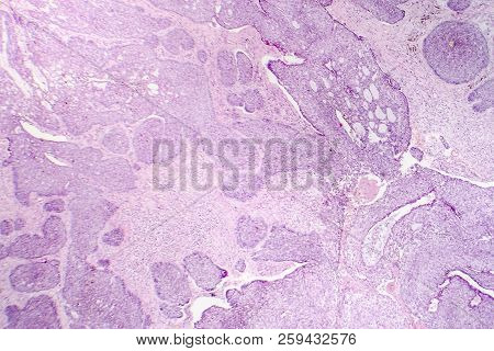 Basal Cell Carcinoma, Image & Photo (Free Trial) | Bigstock