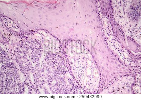 Basal Cell Carcinoma, Image & Photo (Free Trial) | Bigstock