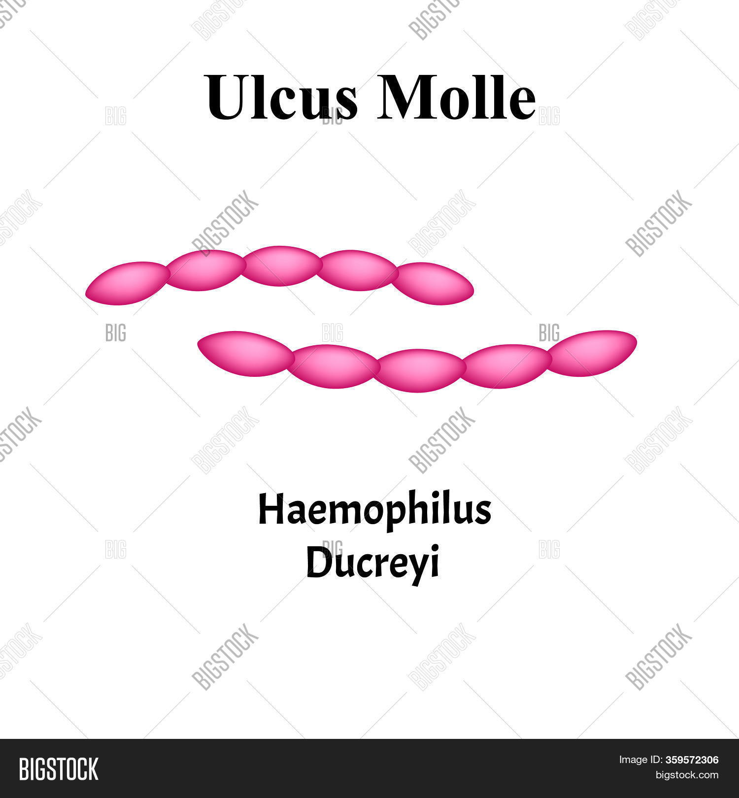 Ulcus Molle, Image & Photo (Free Trial) | Bigstock