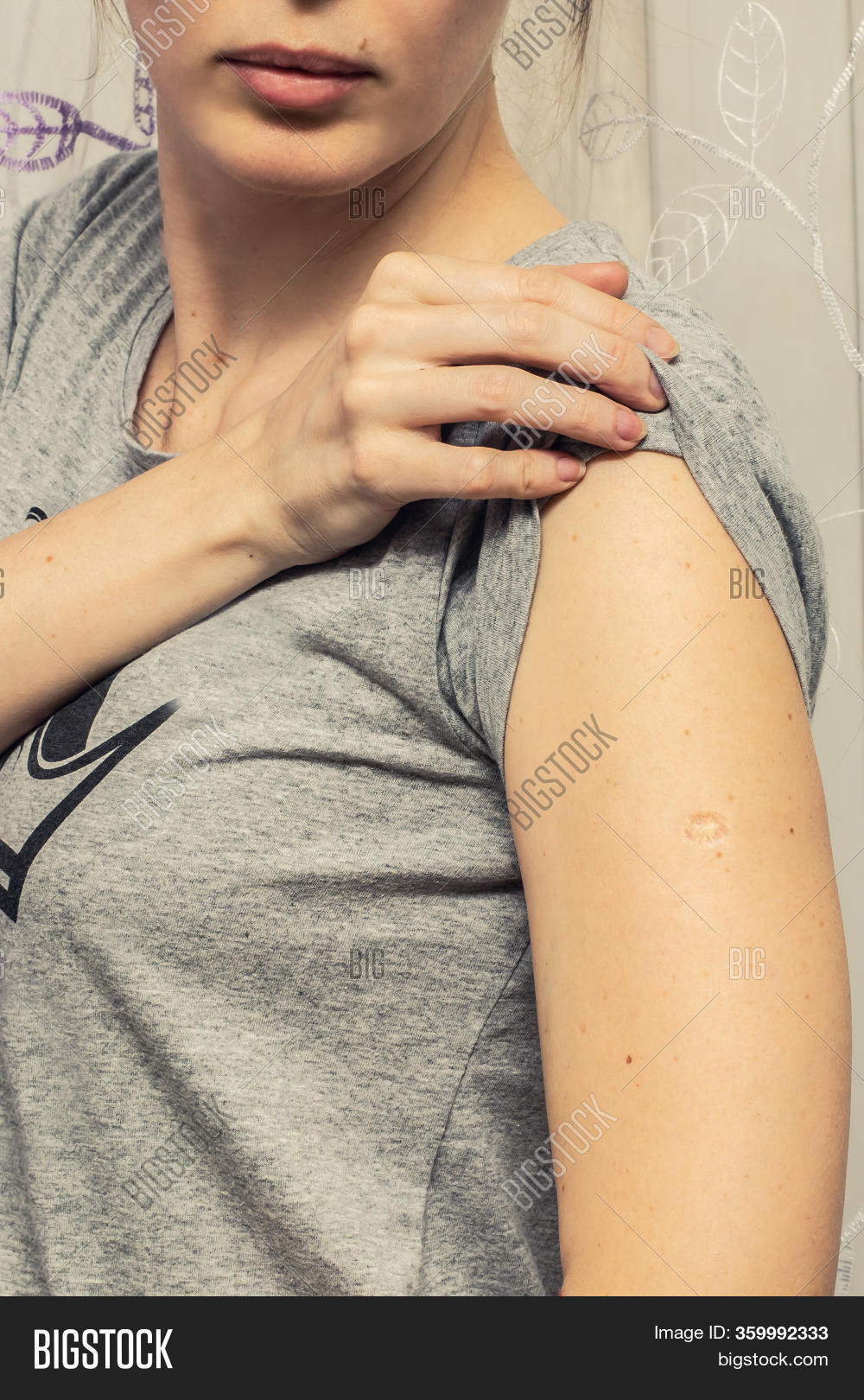 Woman Smallpox Image & Photo (Free Trial) | Bigstock