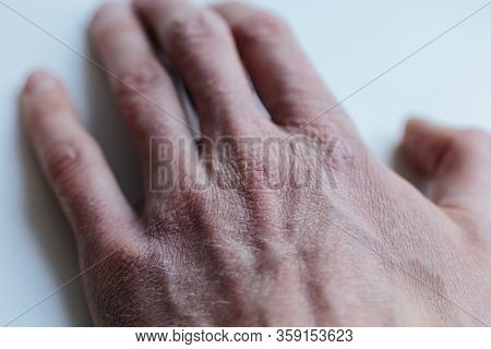 Man Sick Hands, Dry Image & Photo (Free Trial) | Bigstock