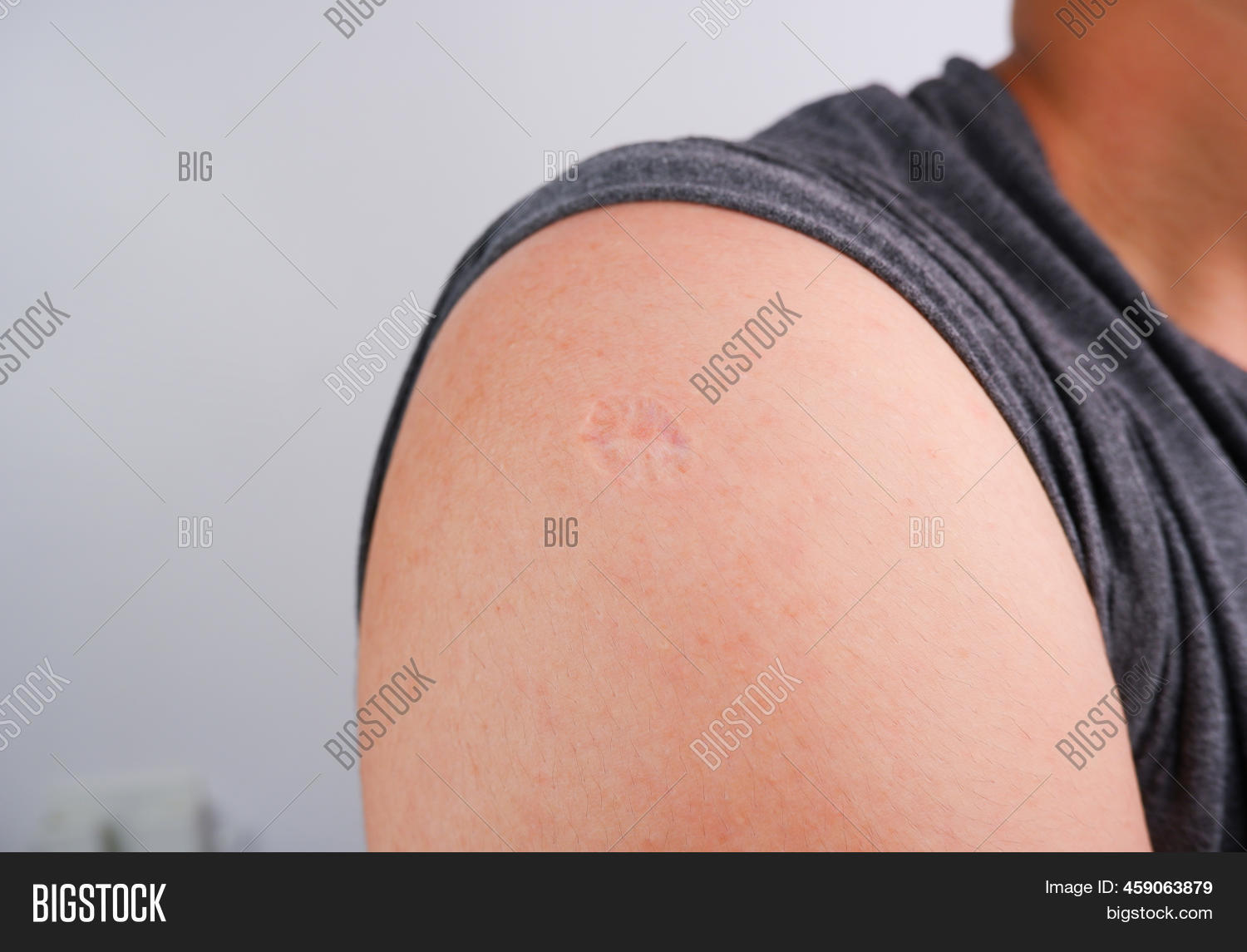 Monkeypox Smallpox Image & Photo (Free Trial) | Bigstock