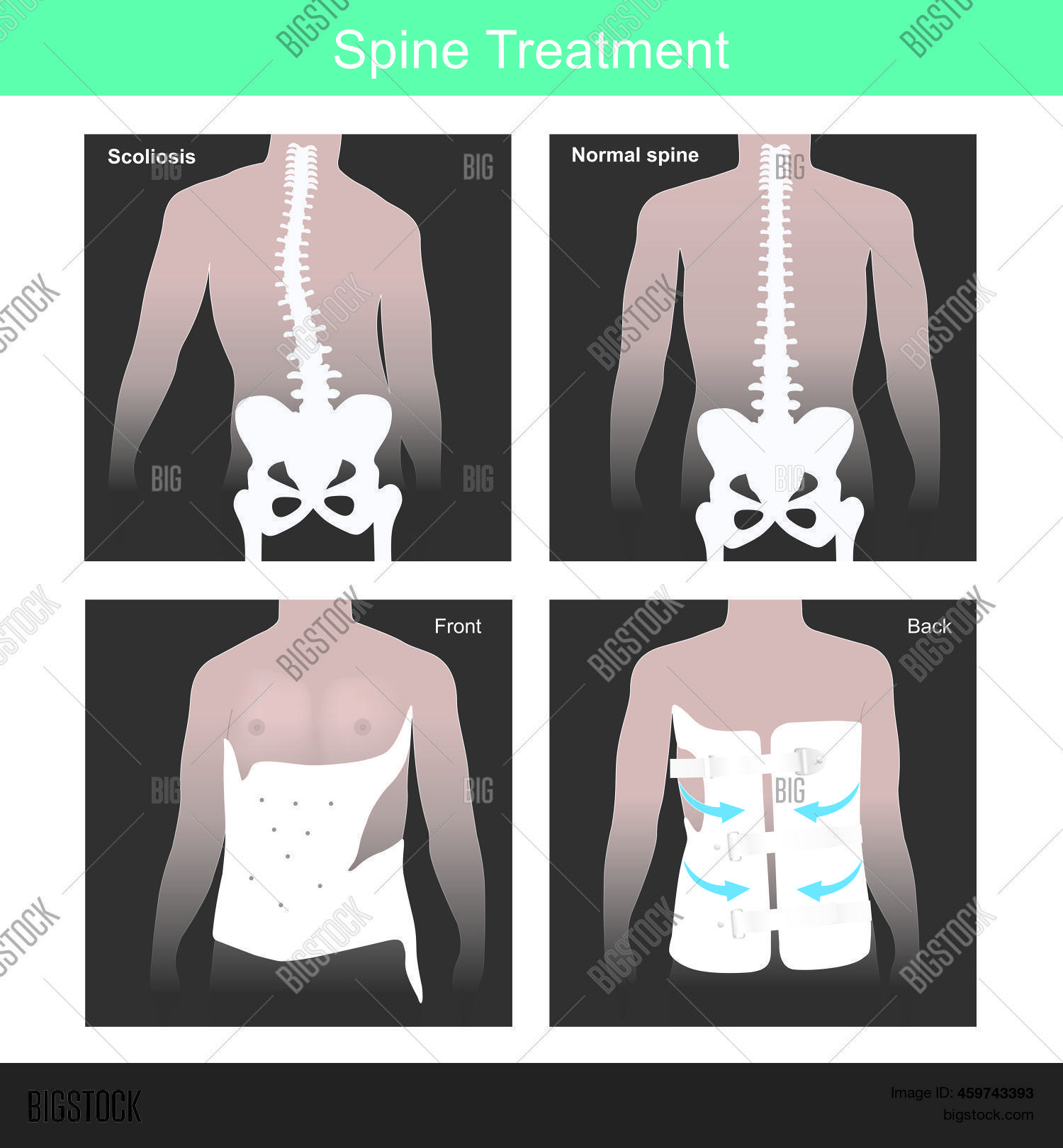 Spine Treatment. He Vector & Photo (Free Trial) | Bigstock
