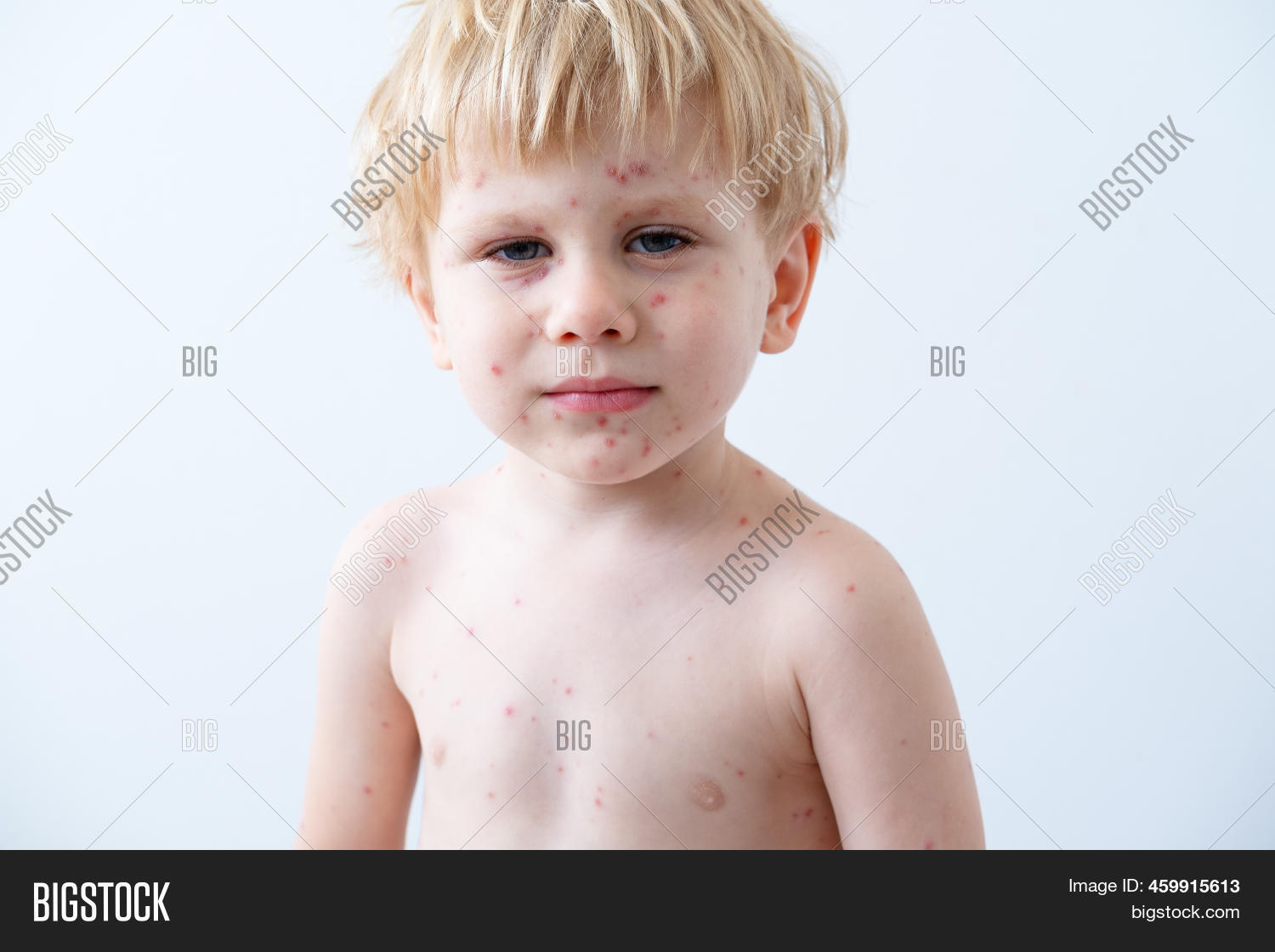 Chickenpox Disease, Image & Photo (Free Trial) | Bigstock