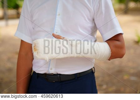Man Broken Arm Cast. Image & Photo (Free Trial) | Bigstock