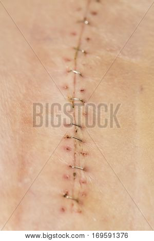 Long Scar Staples Image & Photo (Free Trial) | Bigstock