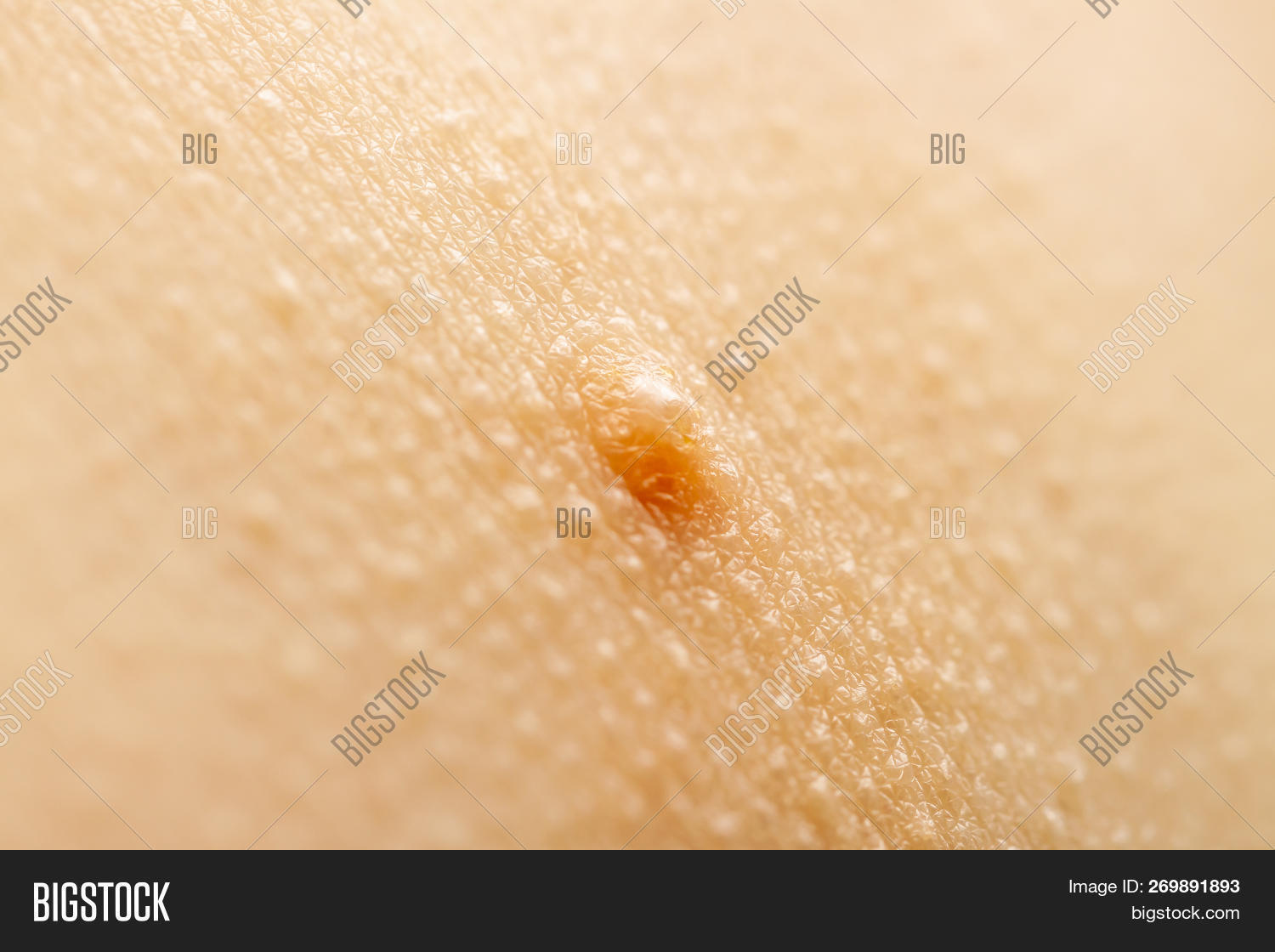 Close Molluscum Image & Photo (Free Trial) | Bigstock