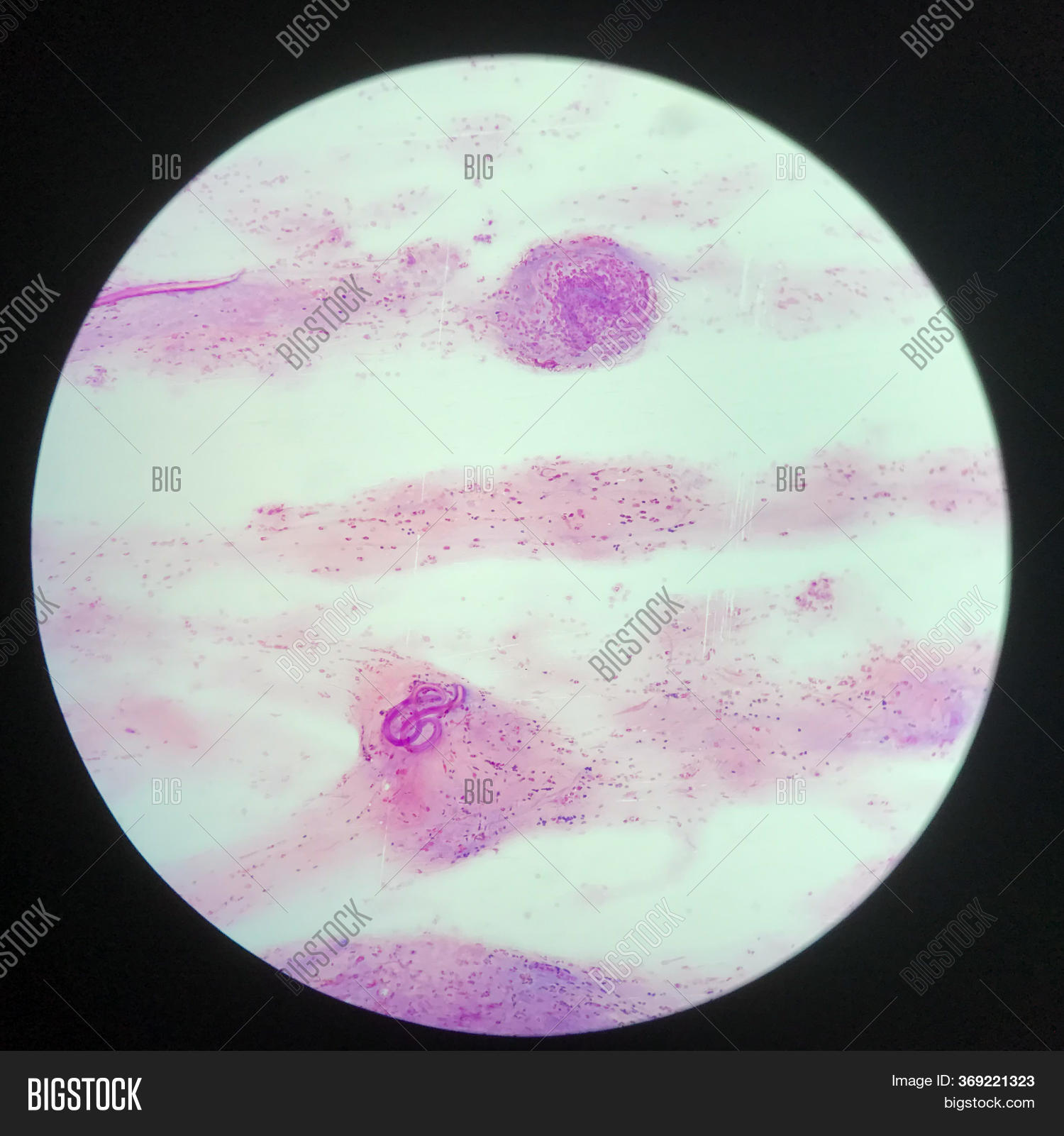 Strongyloides Image & Photo (Free Trial) | Bigstock