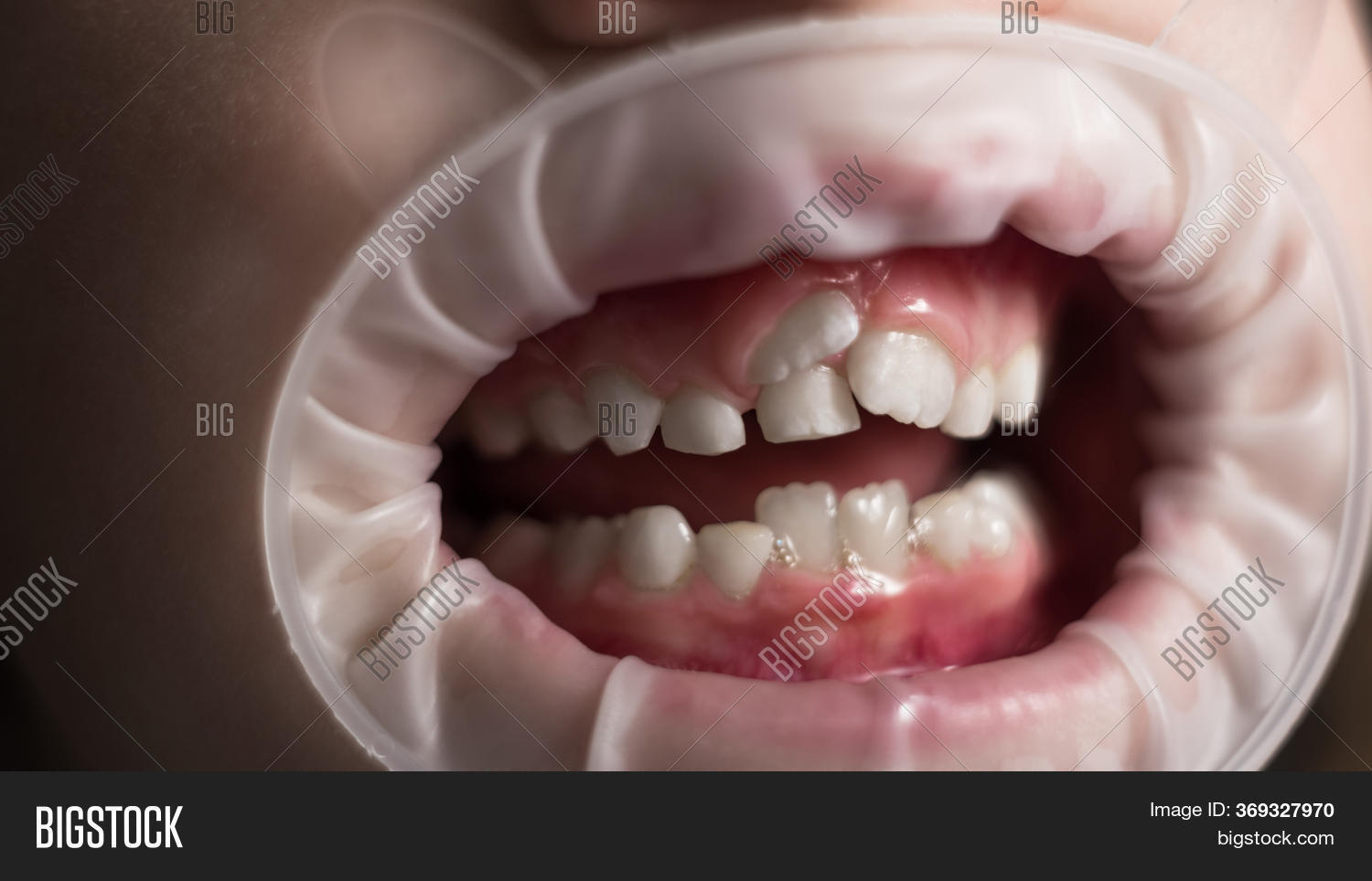 Adult Permanent Teeth Image & Photo (Free Trial) | Bigstock