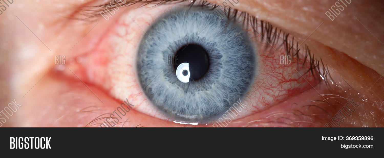 Irritated Left Blue Image & Photo (Free Trial) | Bigstock