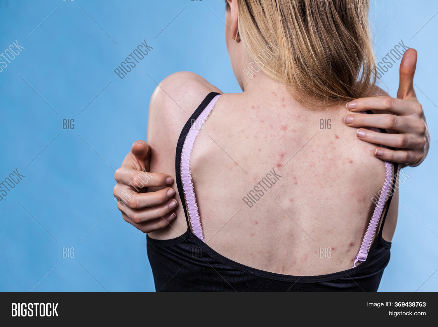 Woman Skin Problem Image & Photo (Free Trial) | Bigstock