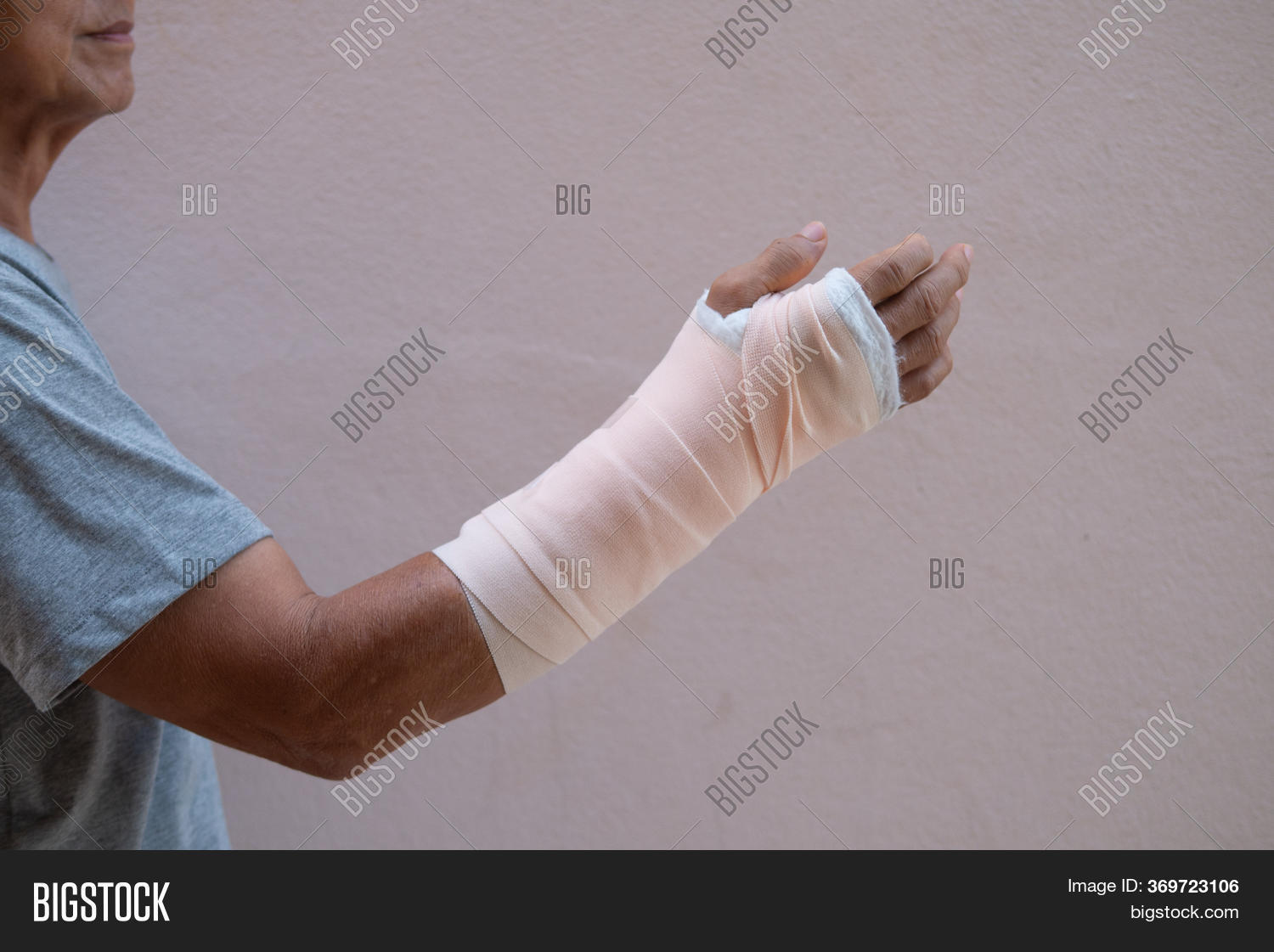 Broken Injued Arm Image & Photo (Free Trial) | Bigstock