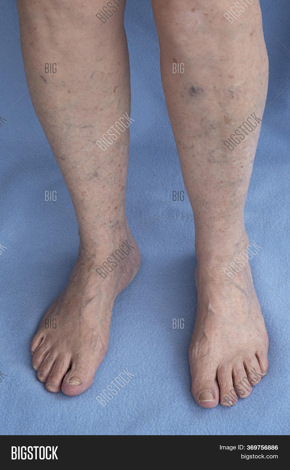 Varicose Veins On Old Image & Photo (Free Trial) | Bigstock