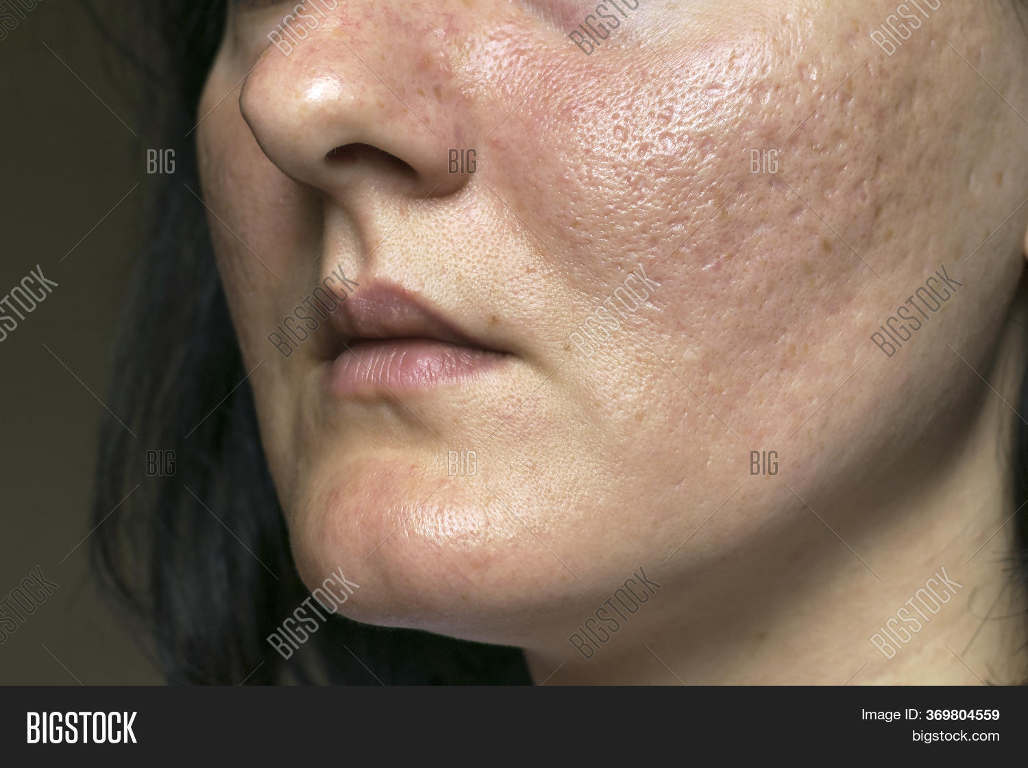 Woman Problematic Skin Image & Photo (Free Trial) | Bigstock
