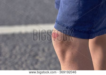 Bruised Wound On Knee Image & Photo (Free Trial) | Bigstock