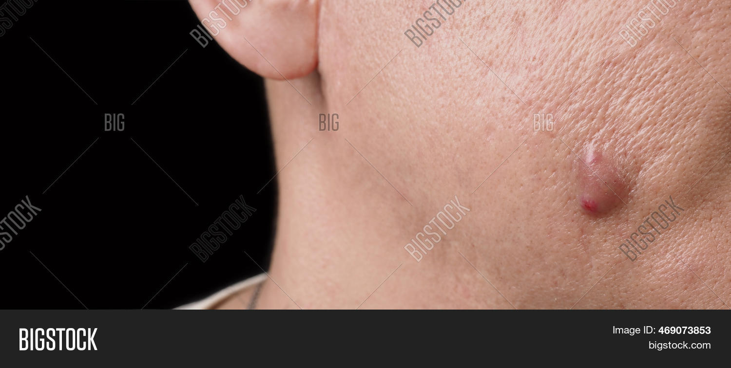Big Acne Cyst Abscess Image & Photo (Free Trial) | Bigstock