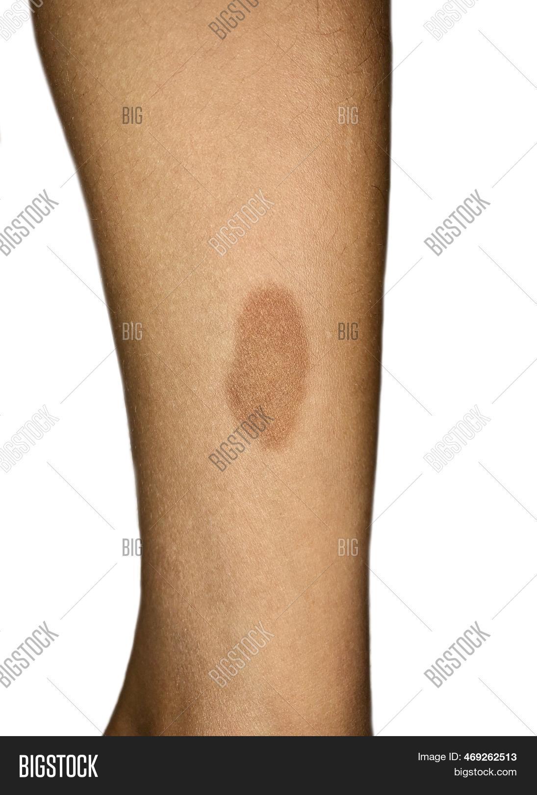 Birthmark On Leg Image & Photo (Free Trial) | Bigstock