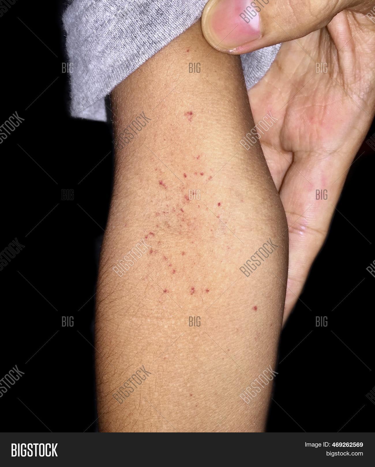 Multiple Red Spots Image & Photo (Free Trial) | Bigstock