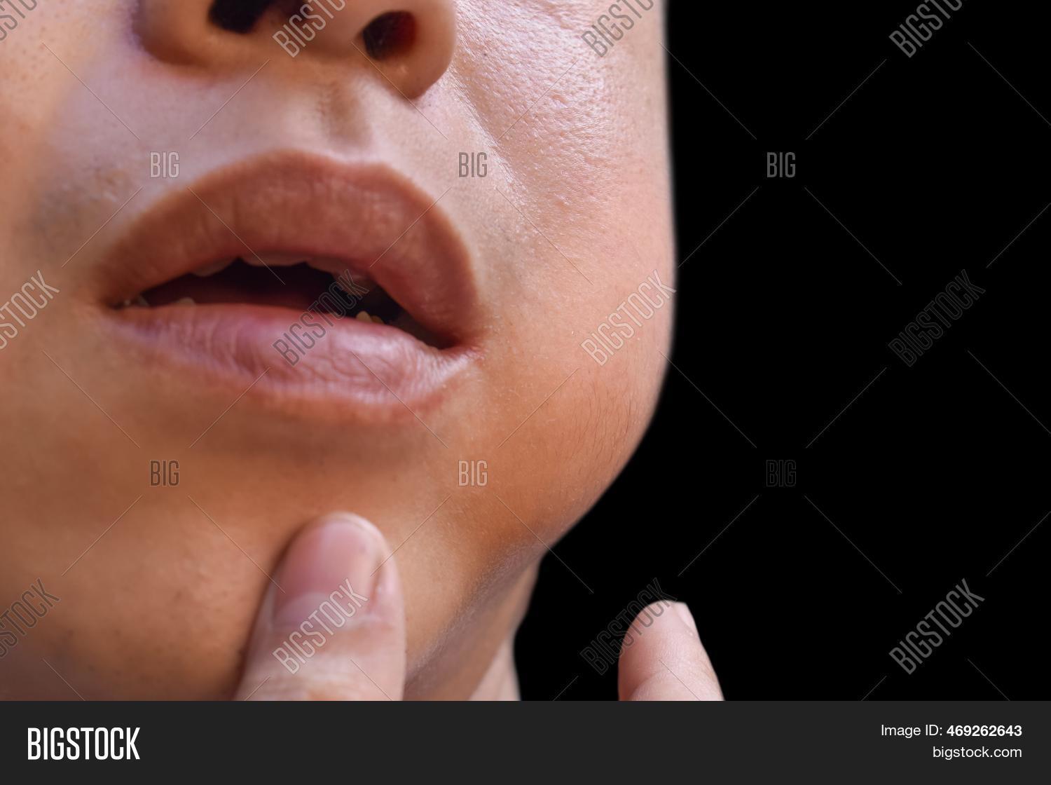 Swelling Cheek Asian Image & Photo (Free Trial) | Bigstock