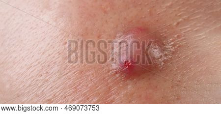 Big Acne Cyst Abscess Image & Photo (Free Trial) | Bigstock
