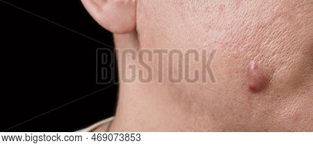 Big Acne Cyst Abscess Image & Photo (Free Trial) | Bigstock
