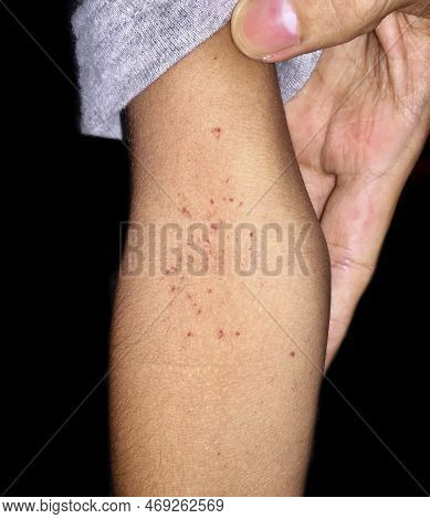 Multiple Red Spots Image & Photo (Free Trial) | Bigstock