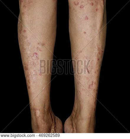 Fungal Infection Image & Photo (Free Trial) | Bigstock