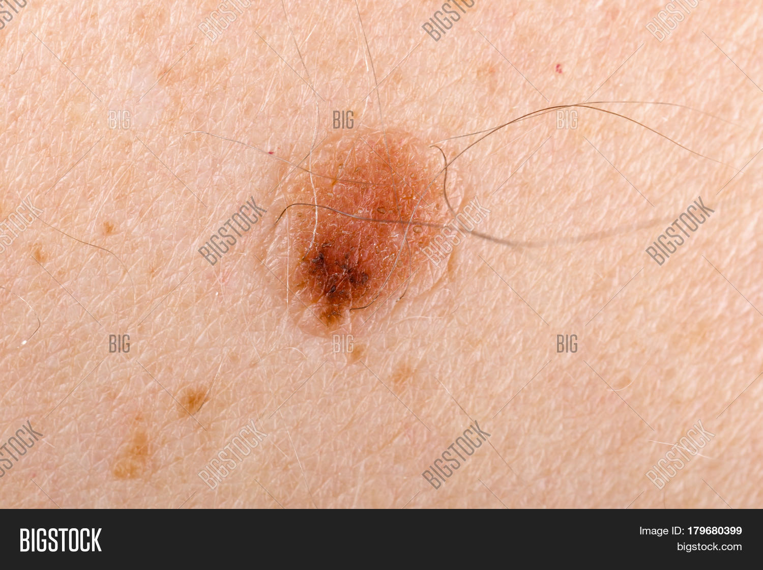 Close Photo Nevus On Image & Photo (Free Trial) | Bigstock