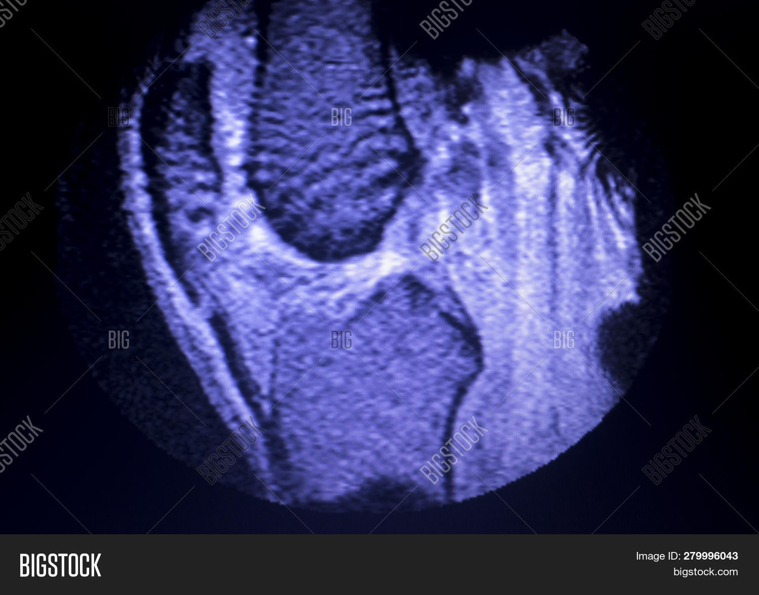 Mri Knee Meniscus Tear Image & Photo (Free Trial) | Bigstock
