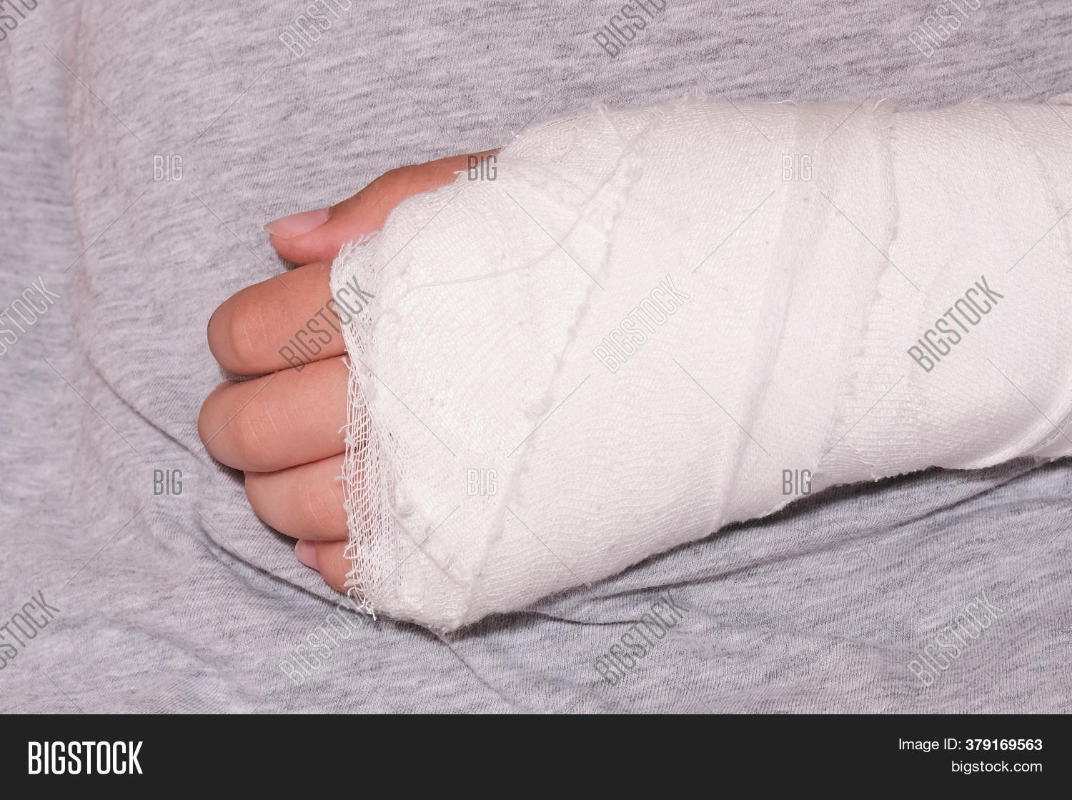 Child Broken Arm Image & Photo (Free Trial) | Bigstock