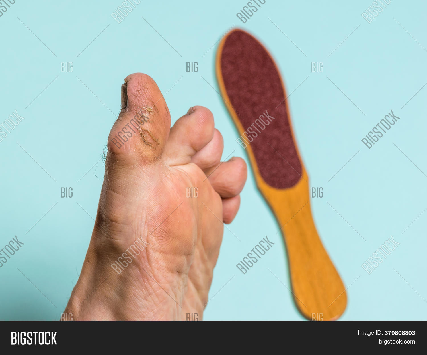 Mens Foot Damaged Skin Image & Photo (Free Trial) | Bigstock