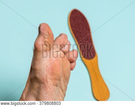 Mens Foot Damaged Skin Image & Photo (Free Trial) | Bigstock