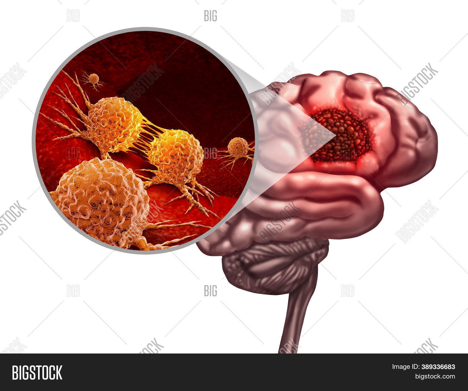 Brain Cancer Anatomy Image & Photo (Free Trial) | Bigstock