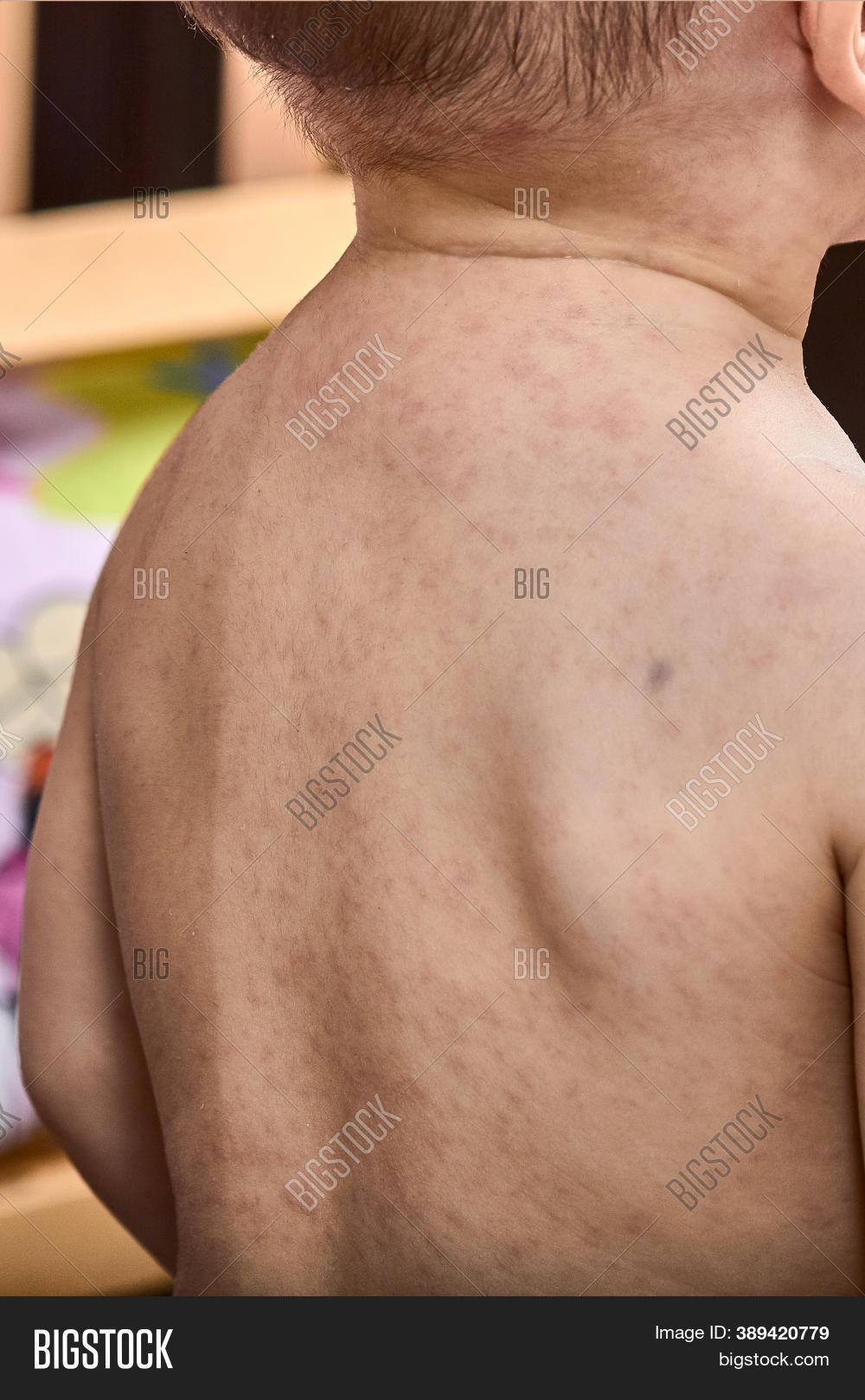 Roseola Rash Viral Image & Photo (Free Trial) | Bigstock
