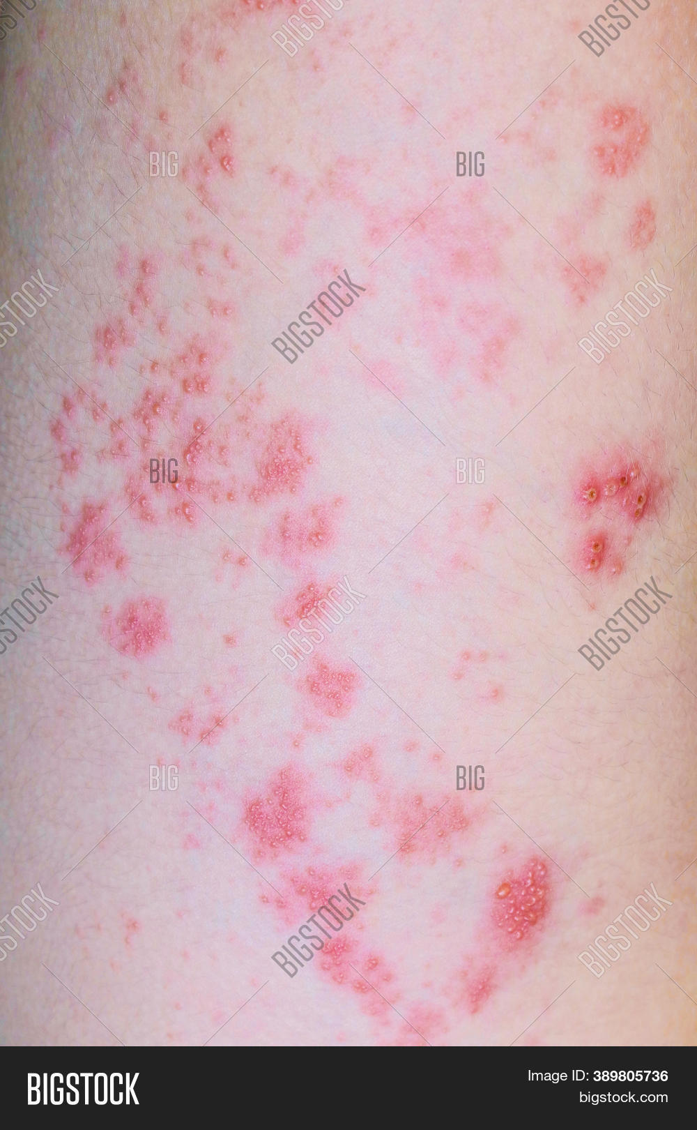 Rash Blisters Viral Image & Photo (Free Trial) | Bigstock