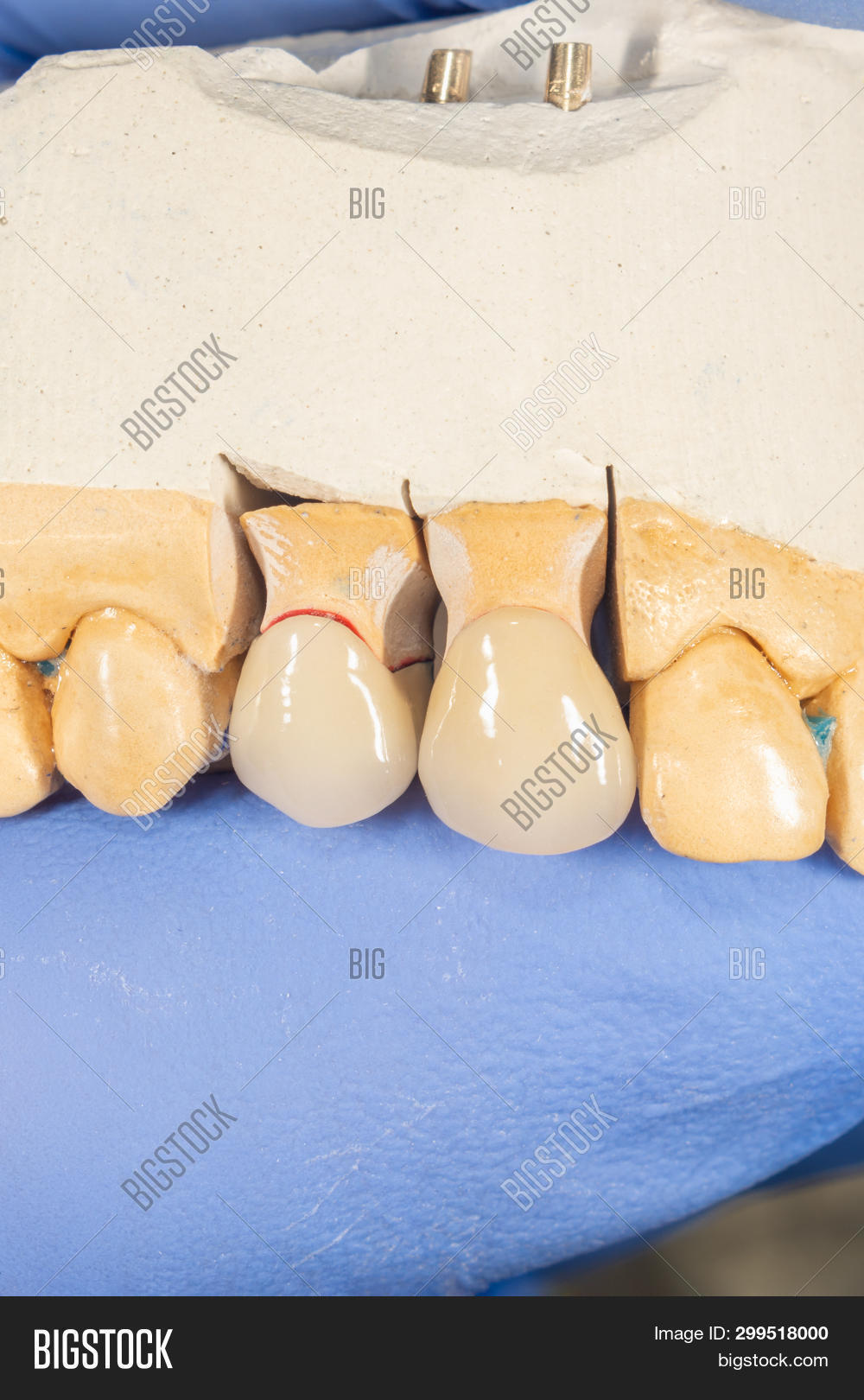 Close- Ceramic Tooth Image & Photo (Free Trial) | Bigstock