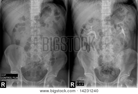 Intravenous Pyelogram Radiology Stock Photo & Stock Images | Bigstock