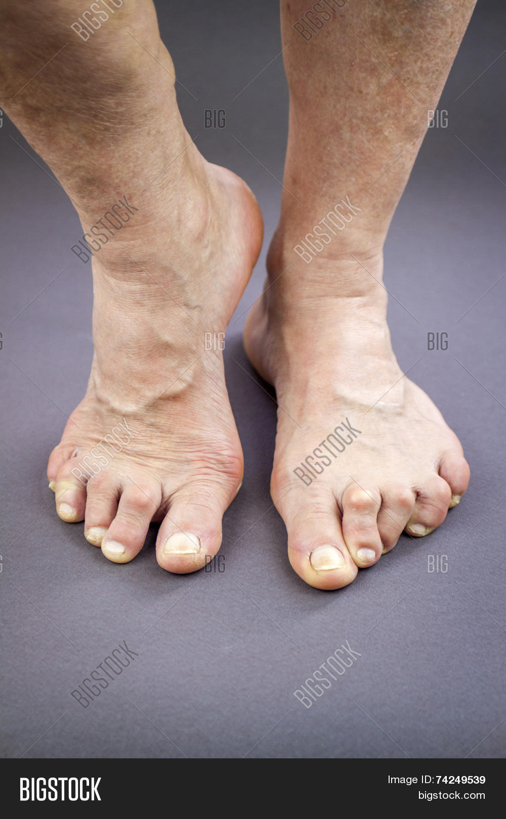 Feet Of Woman Deformed From Rheumatoid Arthritis Stock Photo & Stock ...