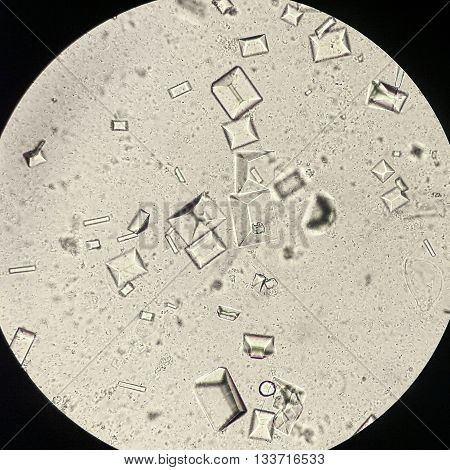 Triple phosphate crystals in human urine under a microscope Stock Photo ...