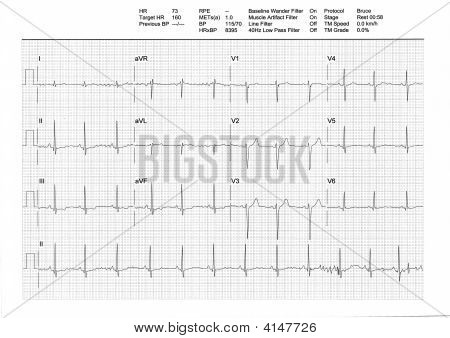 Ekg Ecg Result Treadmill Stress Image & Photo | Bigstock