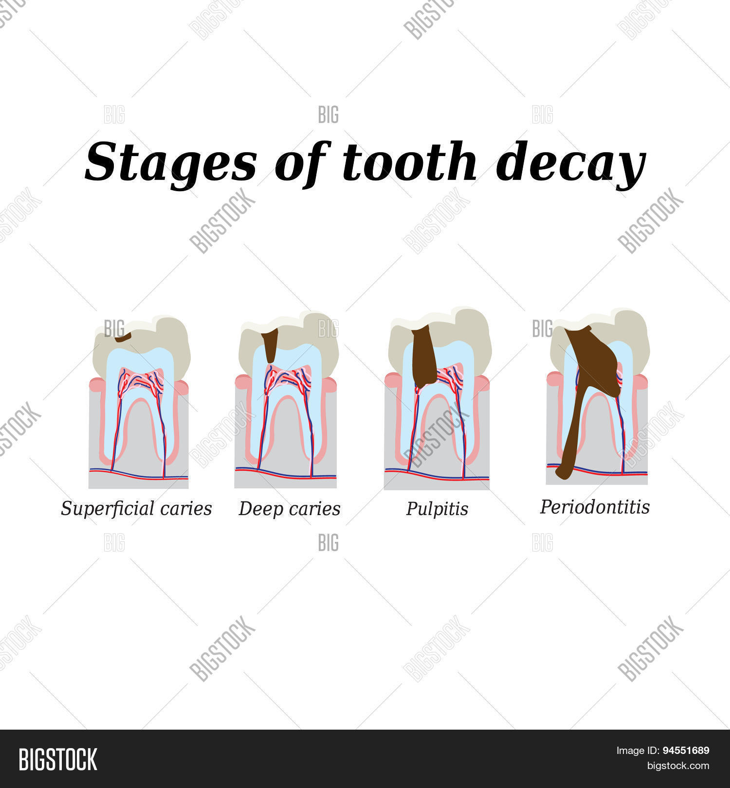 Stages Development Dental Caries. Vector & Photo | Bigstock