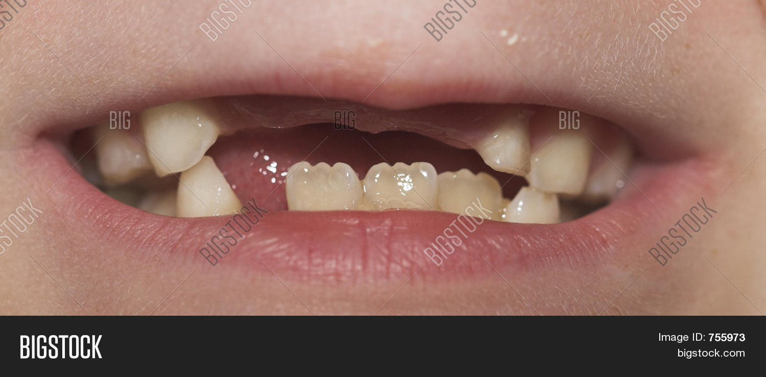 Kids Mouth Missing Teeth Image & Photo | Bigstock