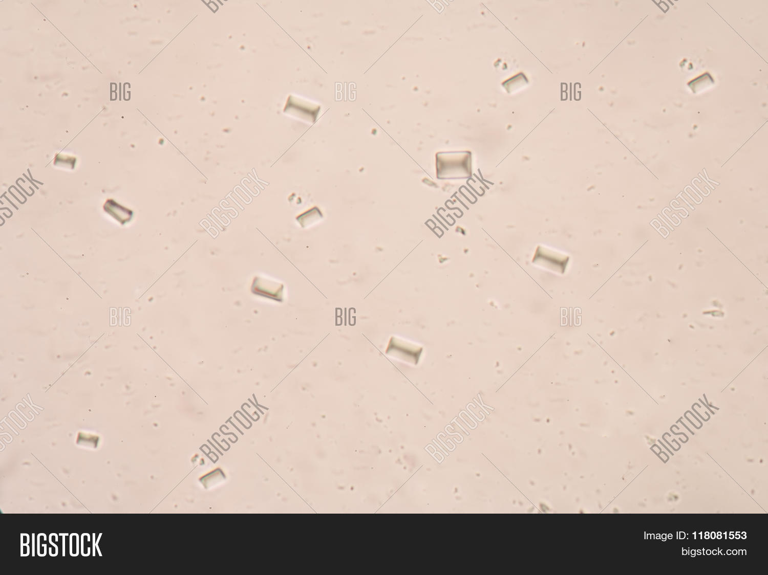 Triple Phosphate Crystals In Human Urine Stock Photo & Stock Images ...